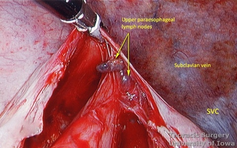 Esophagectomy: Three-field (McKeown) - Laparotomy and Right Thoracoscopy (Thoracotomy) with ...